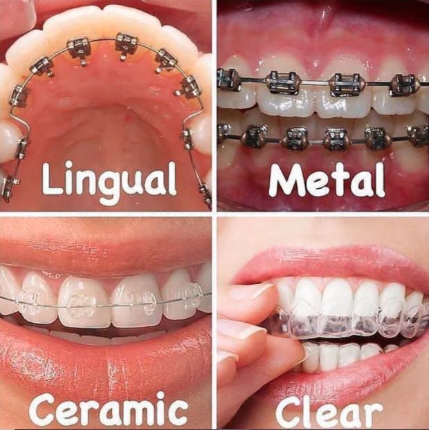 How Braces Straighten Teeth in Children and Adults – Dreamworks Dental ...